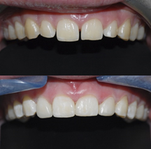 Composite Contouring - Overton Dental Practice