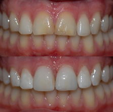 Composite Contouring - Overton Dental Practice